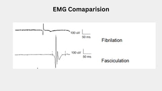 Fasciculation , Fibrillation , clonus and Tetanic contractions | PDF