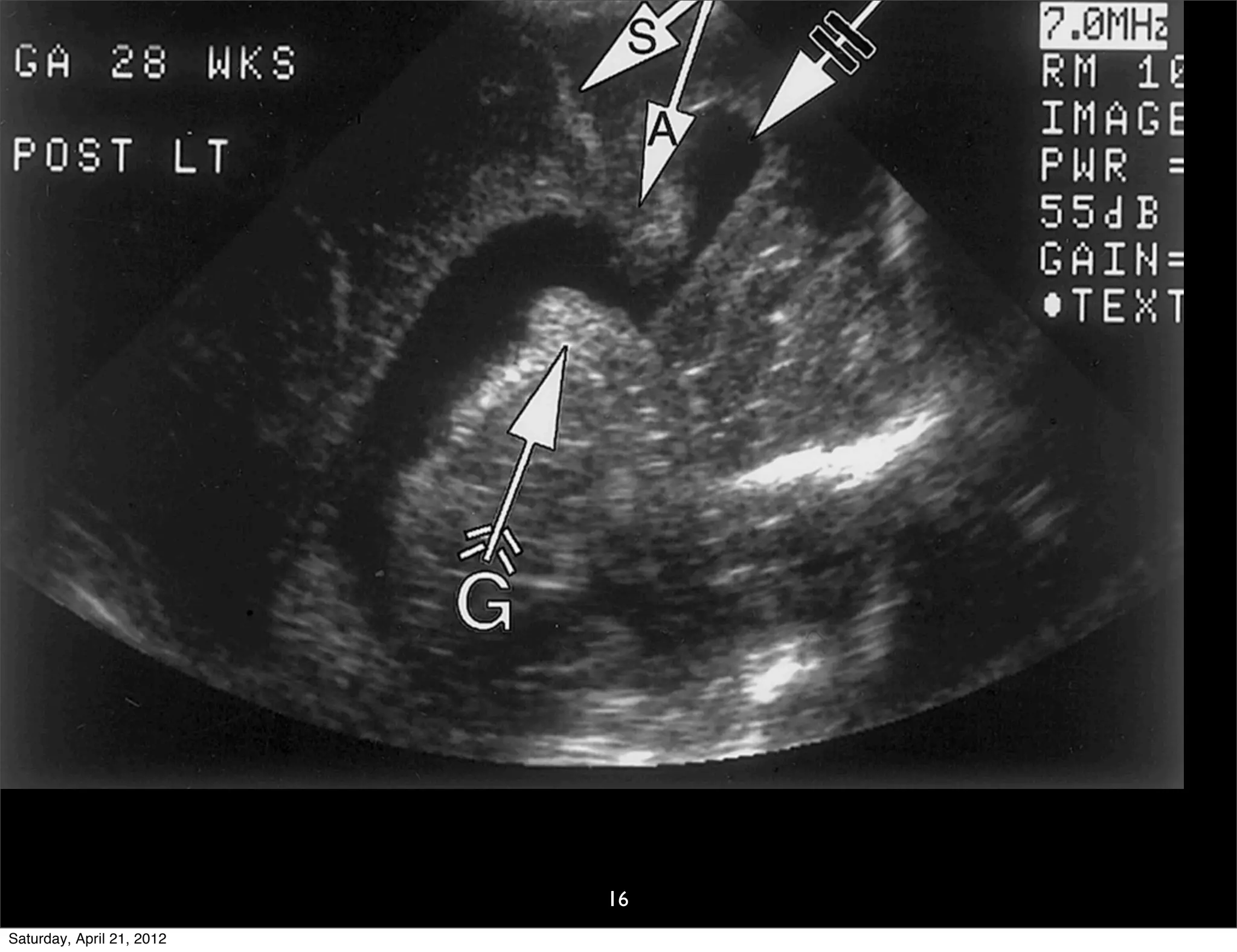 Neonatal Cranial Spinal Sonography | PDF