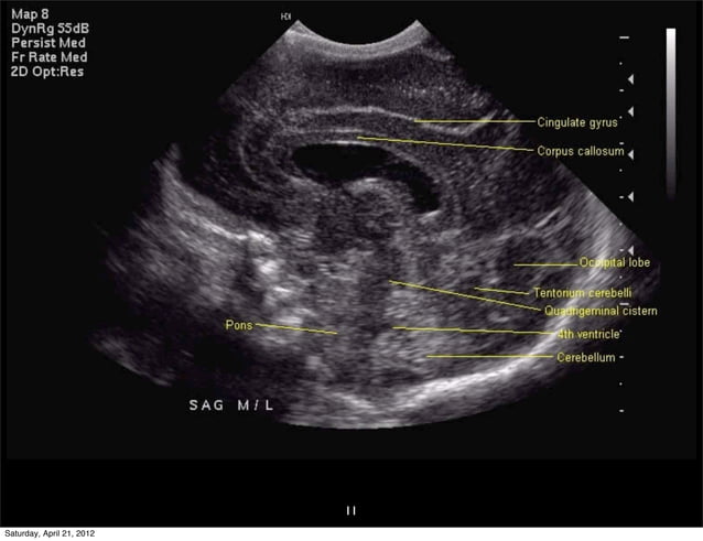Neonatal Cranial Spinal Sonography | PDF
