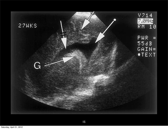 Neonatal Cranial Spinal Sonography | PDF