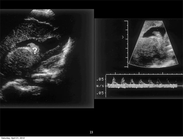 Neonatal Cranial Spinal Sonography | PDF