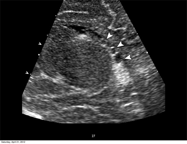 Neonatal Cranial Spinal Sonography | PDF