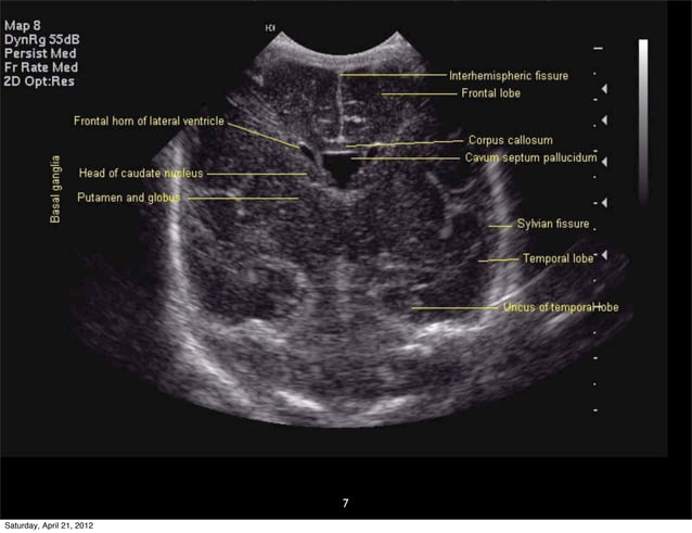 Neonatal Cranial Spinal Sonography | PDF