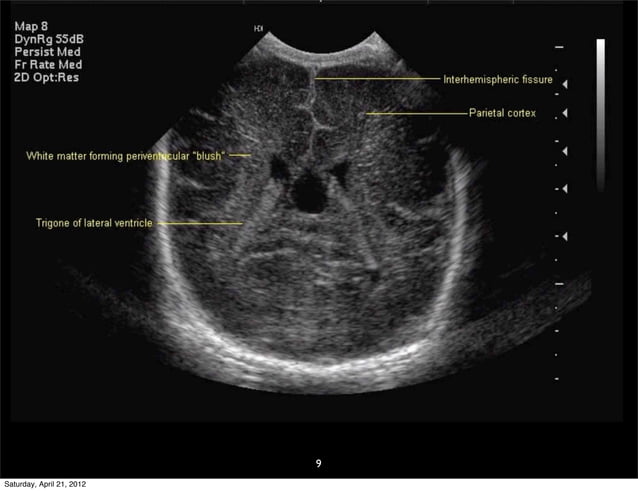 Neonatal Cranial Spinal Sonography | PDF