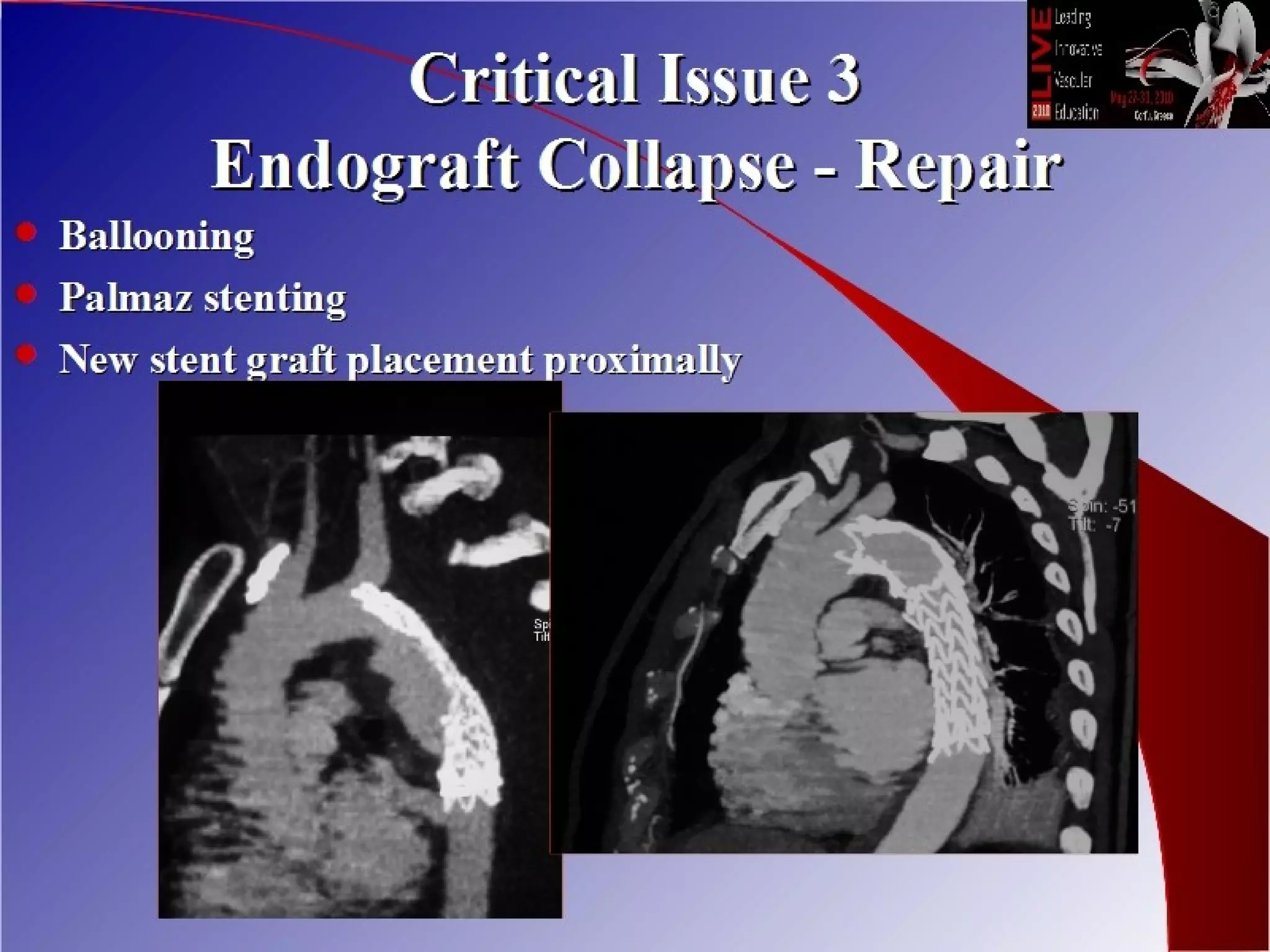 Endovascular repair of traumatic aortic transection | PPT