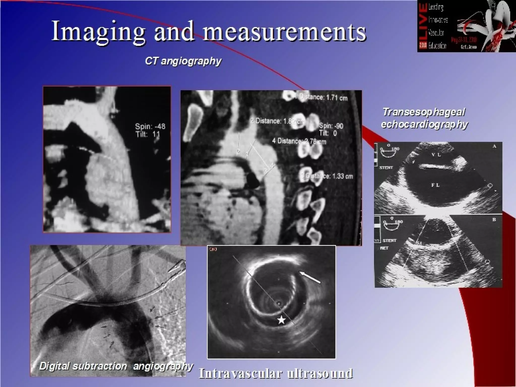 Endovascular repair of traumatic aortic transection | PPT