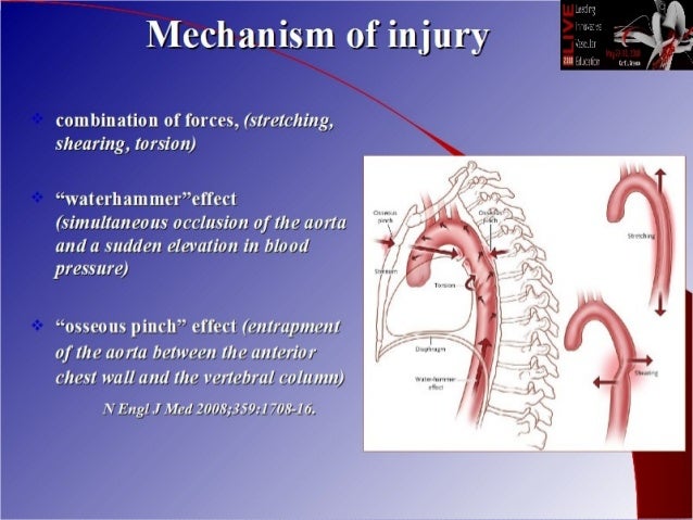 Endovascular repair of traumatic aortic transection