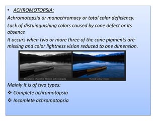 Color vision and its anomalies | PPTX