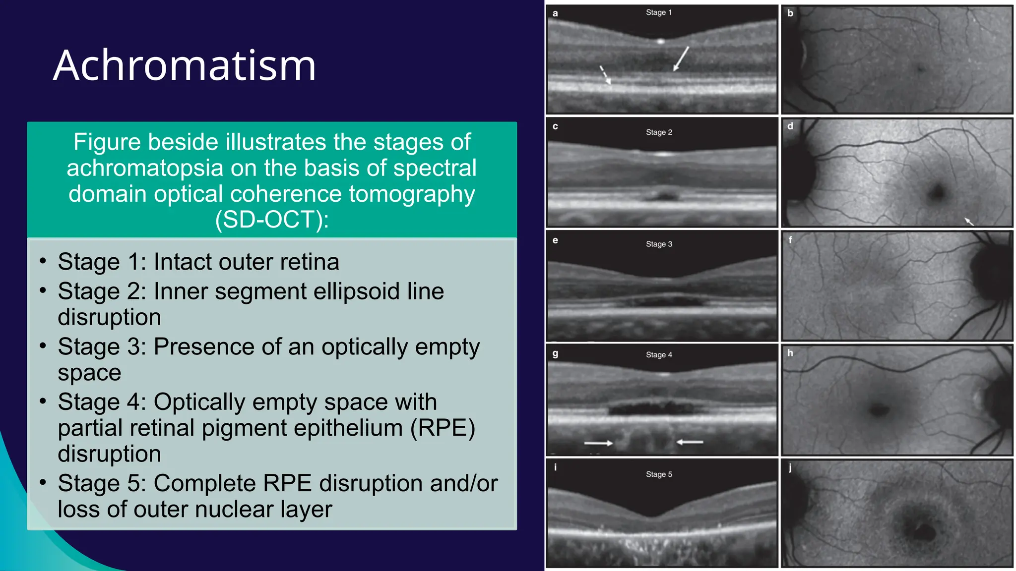 color vision congenital and stationary retinal | PPTX