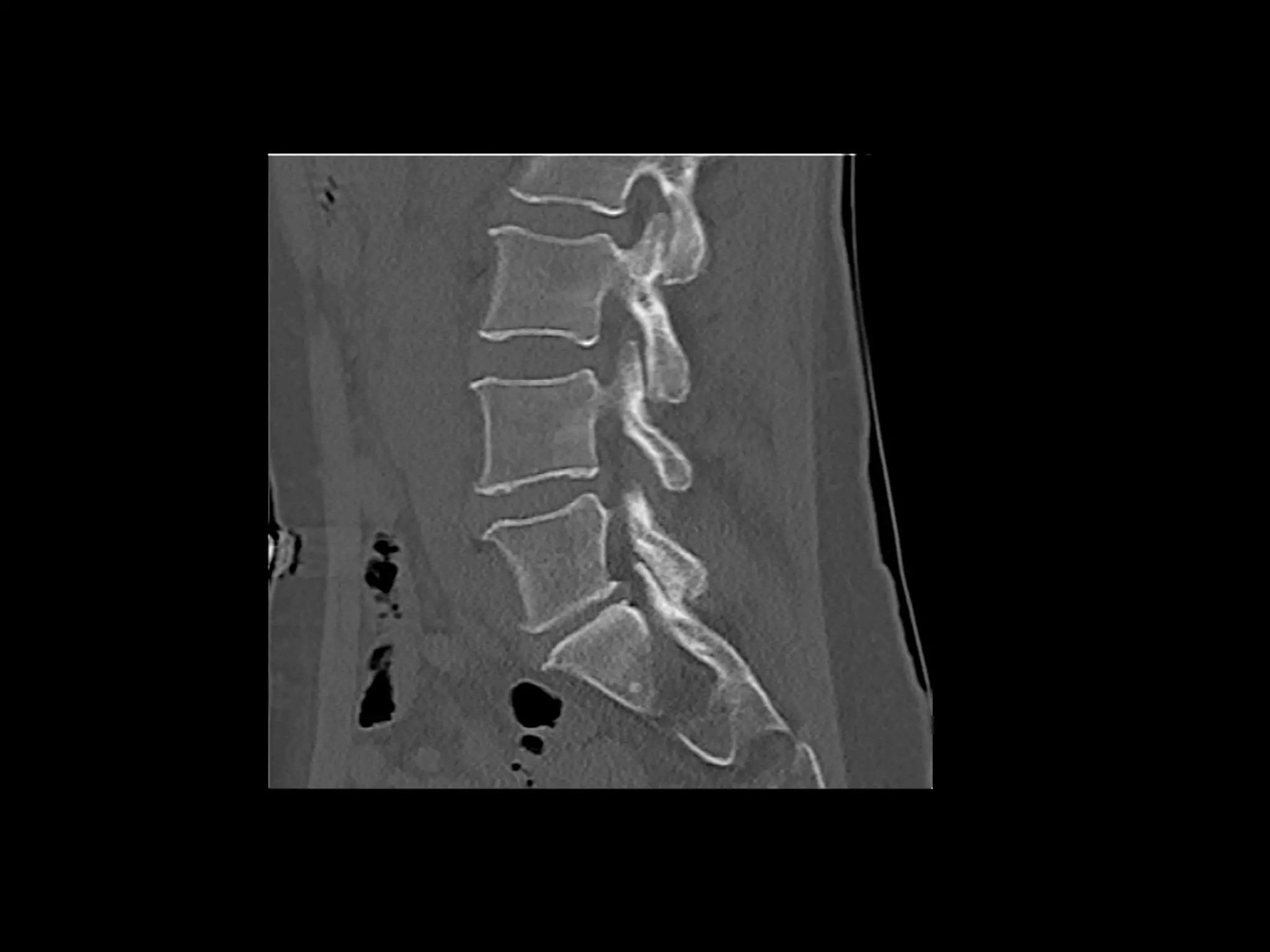 Spinal metastases | PDF