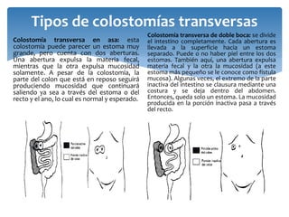 Colostomia | PPTX