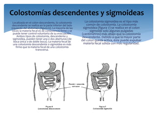 Colostomia | PPTX