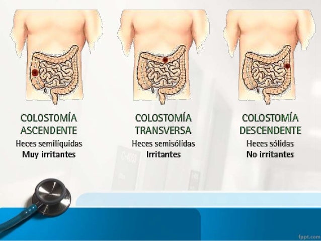 COLOSTOMIA - TECNICA QUIRURGICA E INSTRUMENTAL