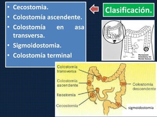 Colostomia topicos-1 | PPTX