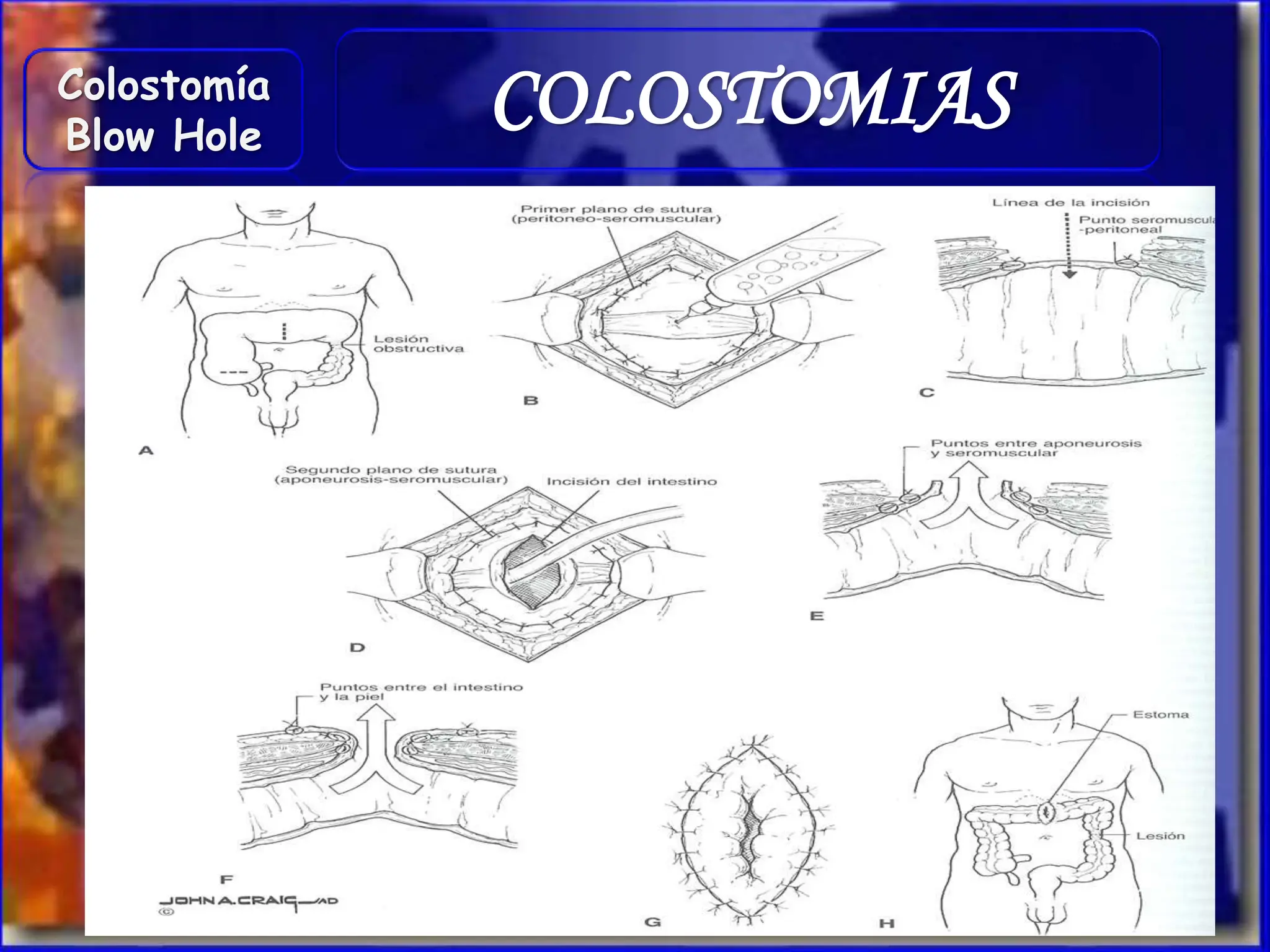 COLOSTOMIA , tipos y descripcionesJOHANNA.pptx