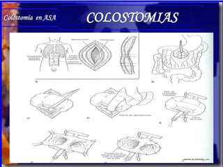 COLOSTOMIA , tipos y descripcionesJOHANNA.pptx