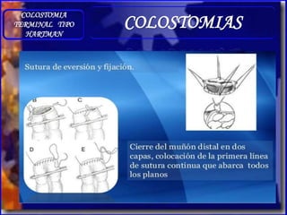 COLOSTOMIA , tipos y descripcionesJOHANNA.pptx