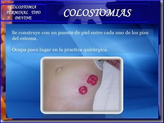 COLOSTOMIA , tipos y descripcionesJOHANNA.pptx