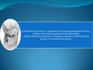 Colostomia,ostomia | PPTX