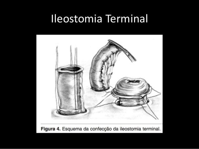 Ostomias