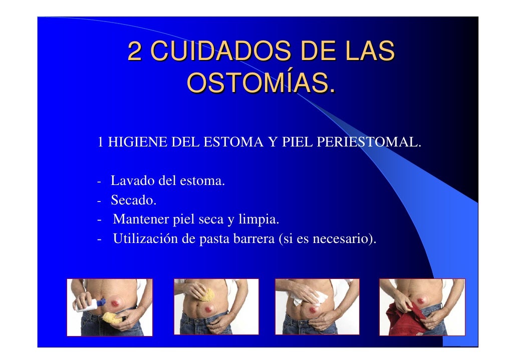 Colostomias ileostomias