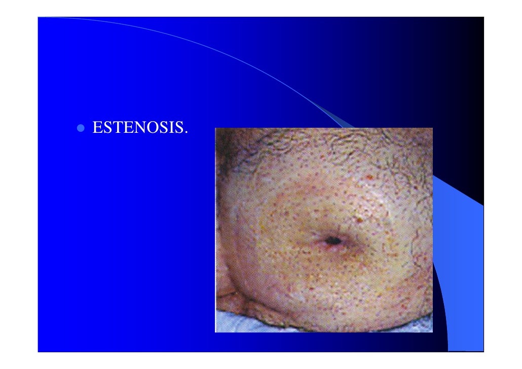 Colostomias ileostomias