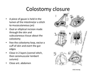 Colostomy | PPSX