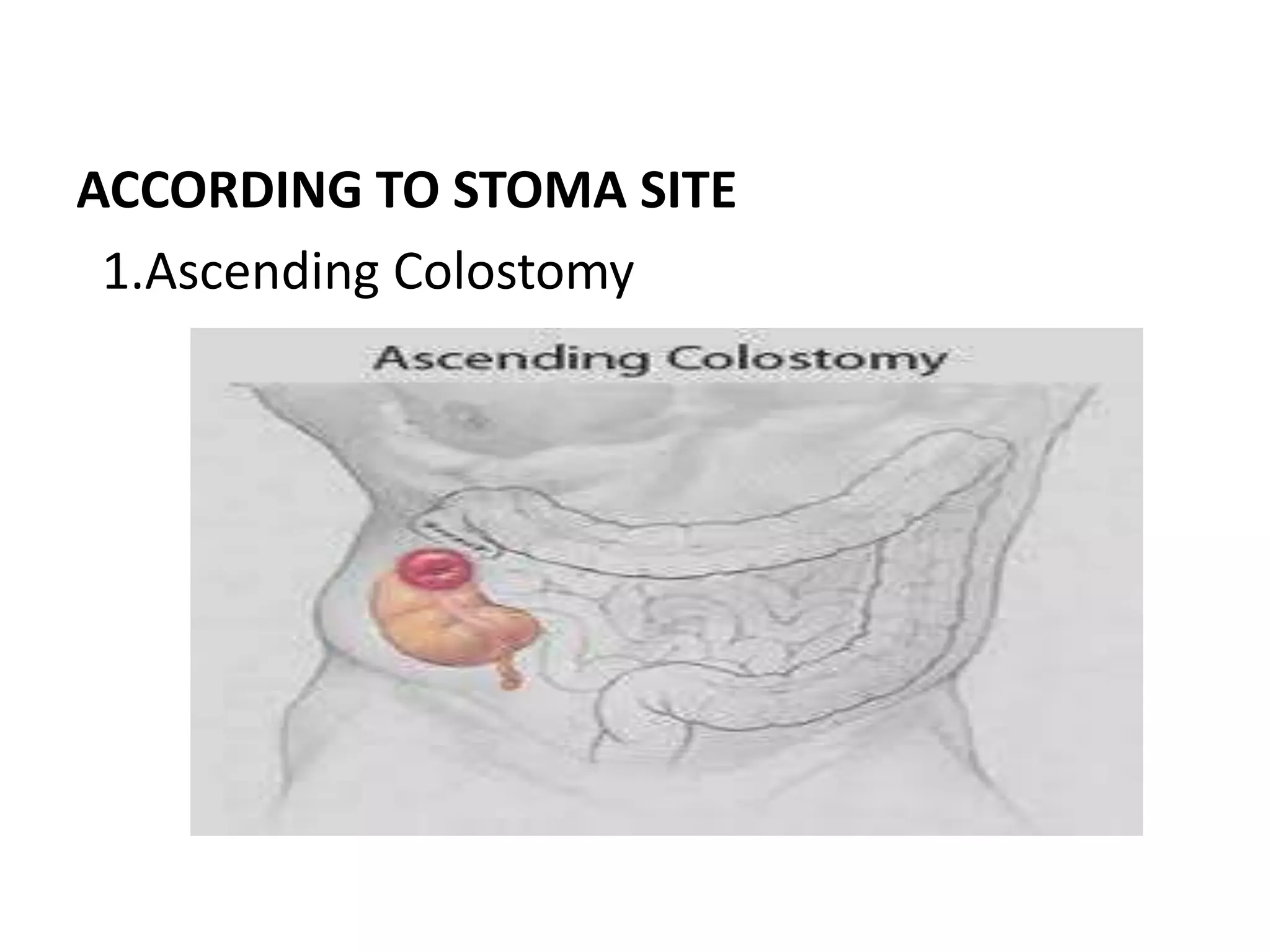 Colostomy | PPTX