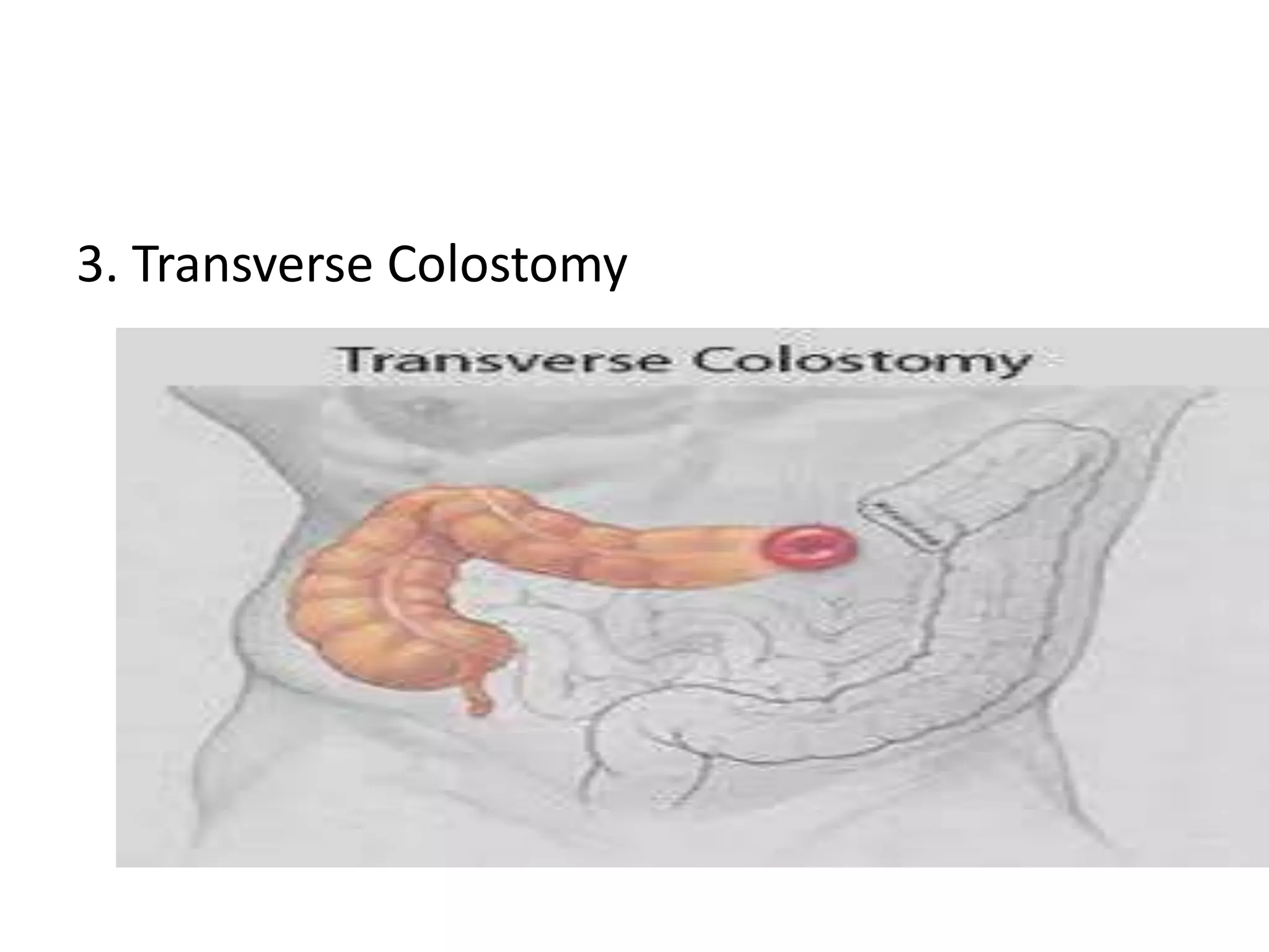 Colostomy | PPTX | Digestive Disorders | Diseases and Conditions