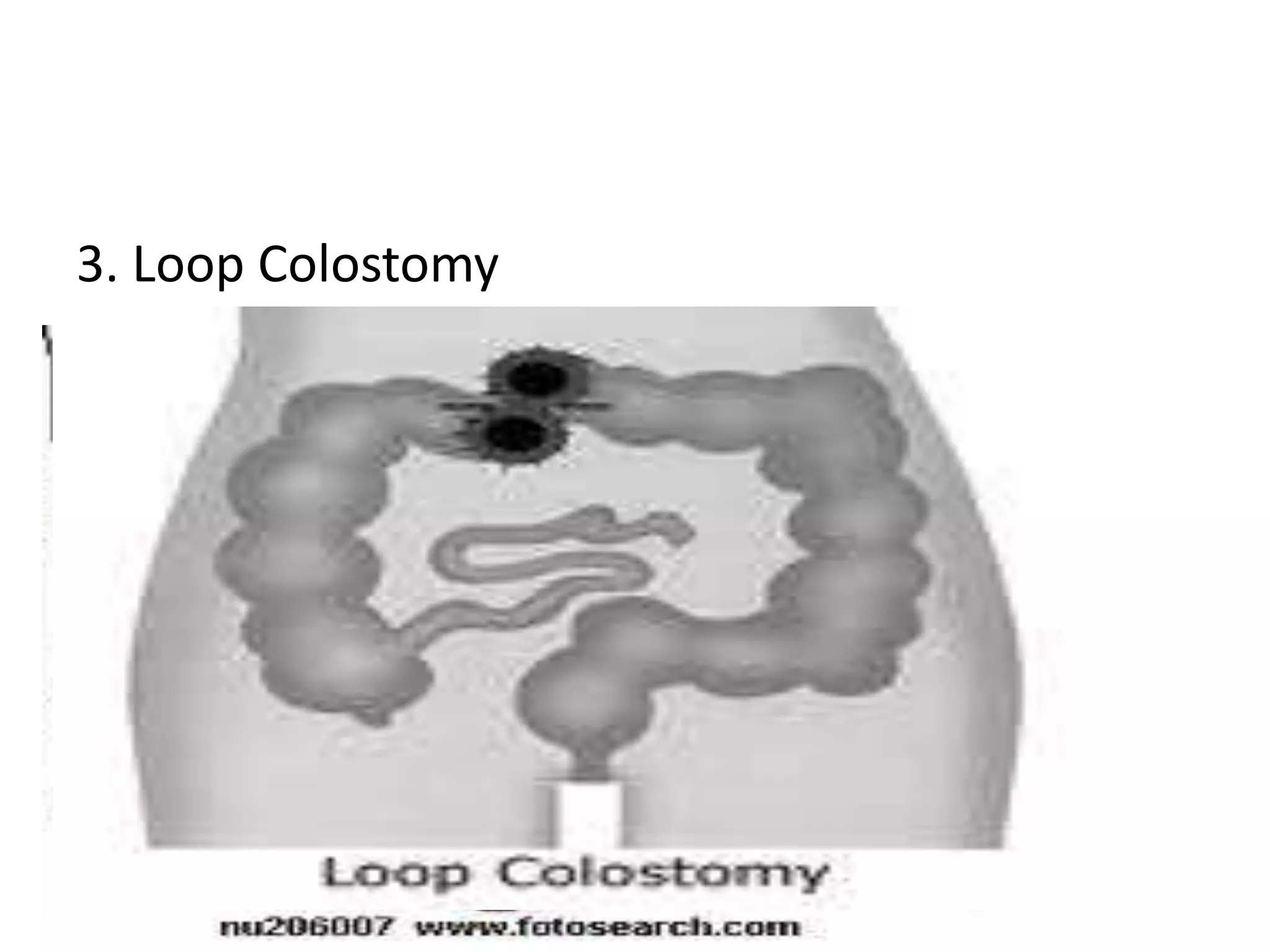 Colostomy | PPTX