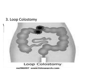 Colostomy | PPTX