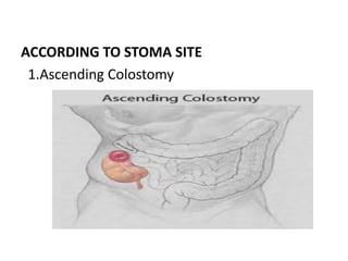 Transverse Colostomy