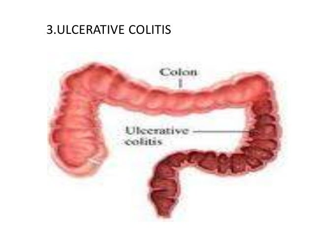 Colostomy