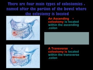 Colostomy | PPT