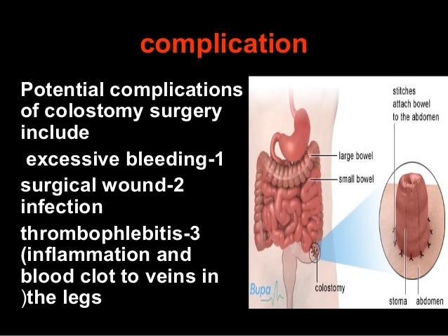 Colostomy