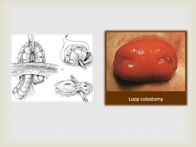 colostomy-2.ppt