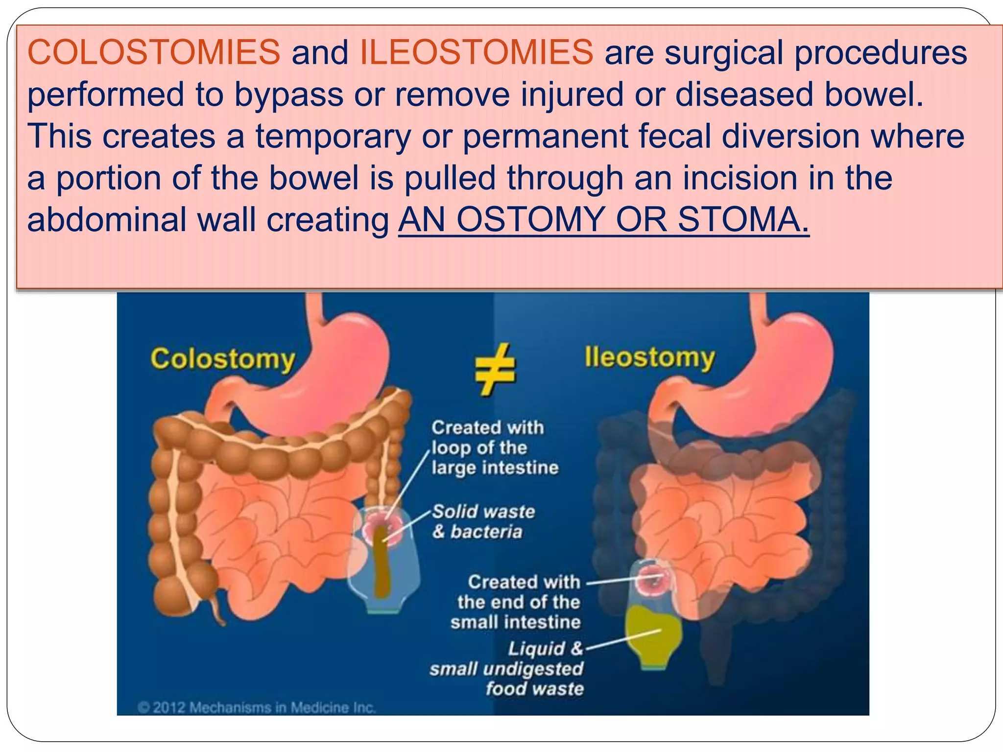 Colostomy care | PPTX