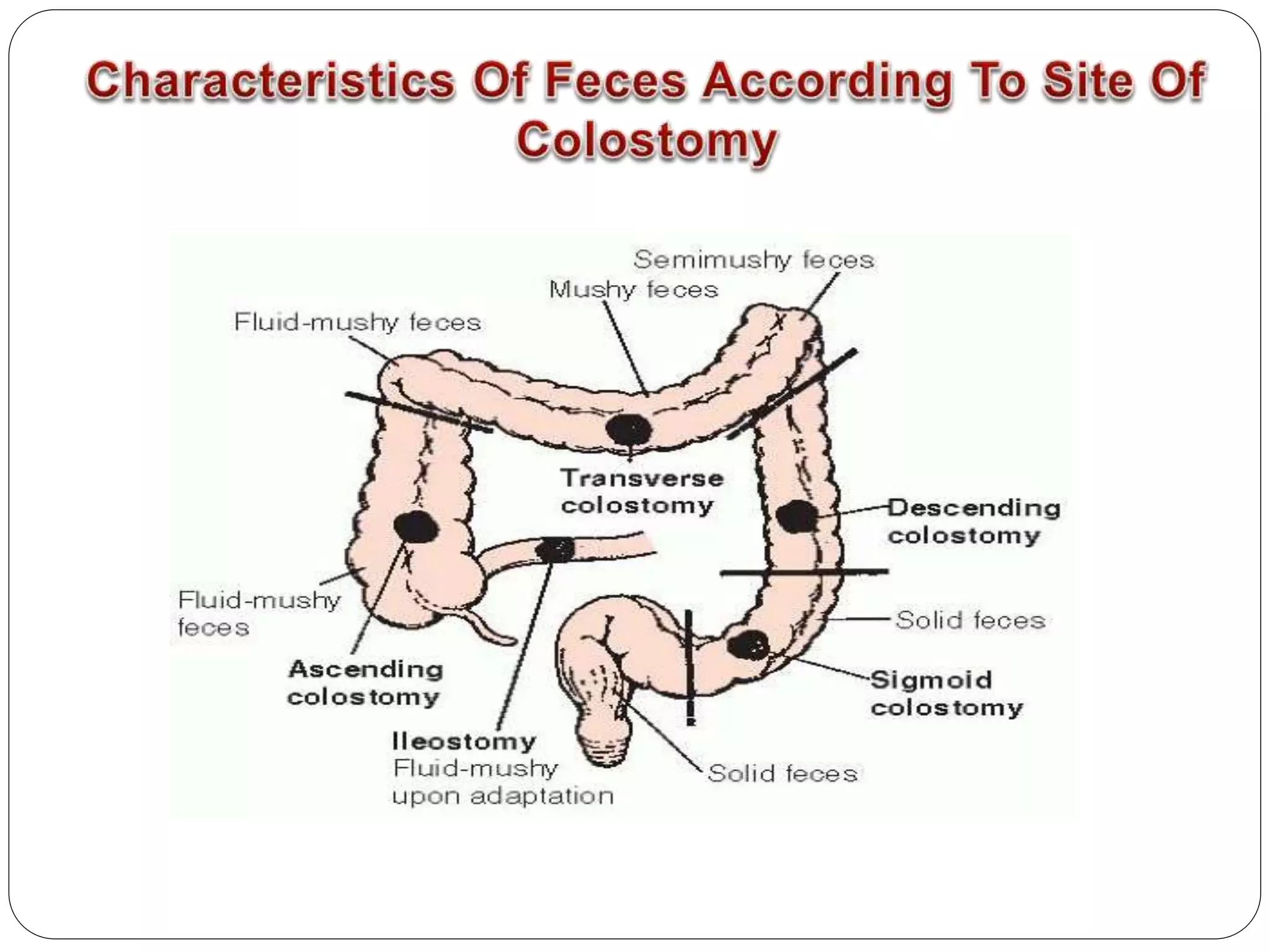 Colostomy care | PPTX