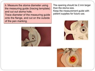 Colostomy care | PPTX