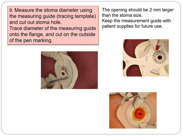 Colostomy care | PPTX
