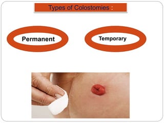 Colostomy care | PPTX