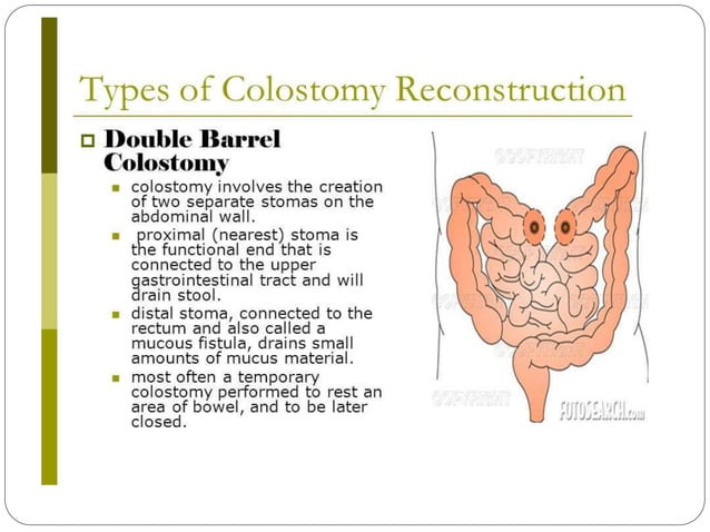 Colostomy care | PPTX
