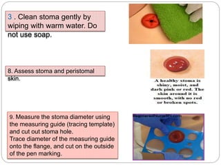 Colostomy care | PPT