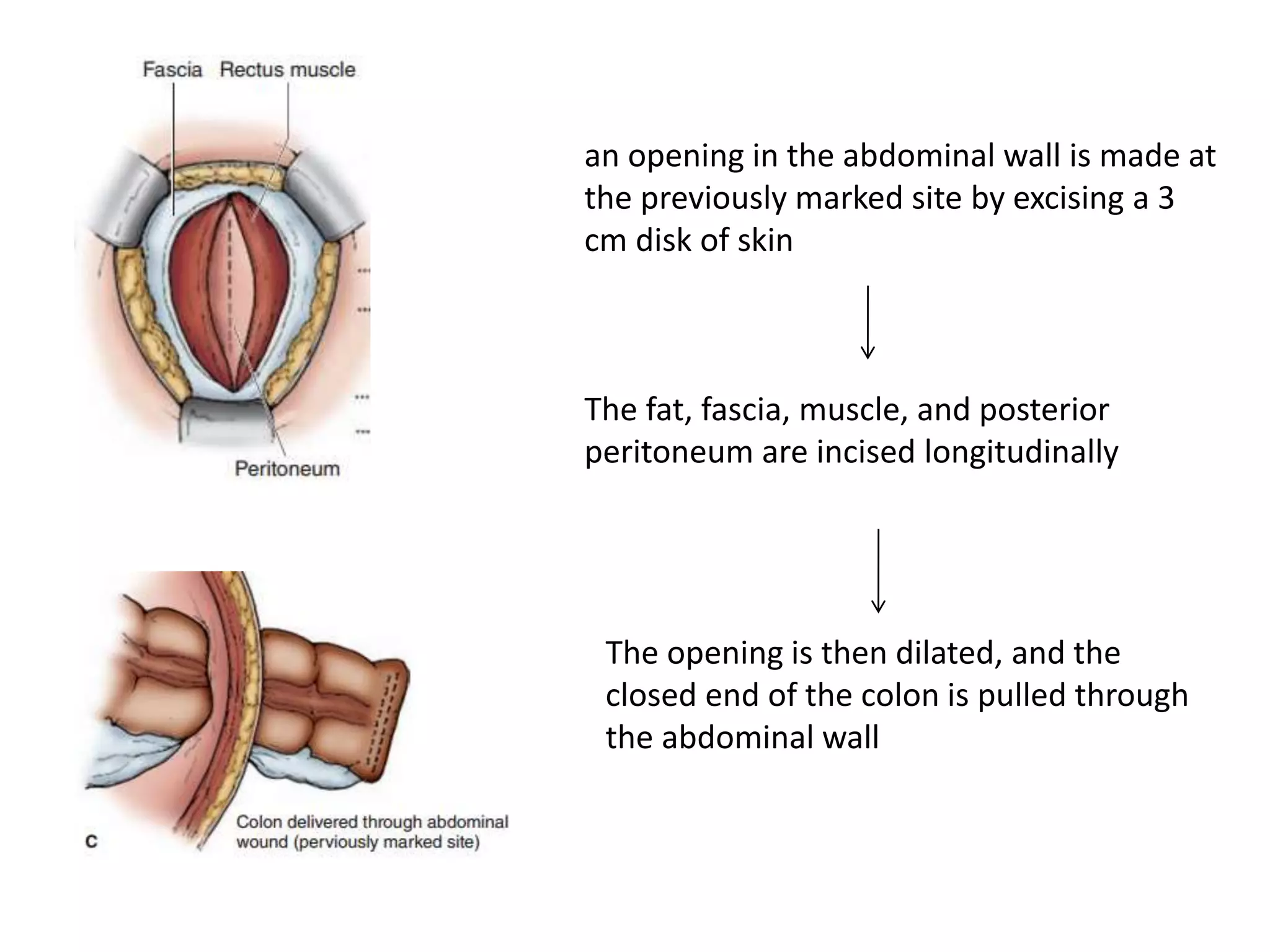 Colostomy -Large intestine | PPTX