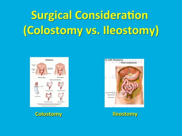 Colostomy complications | PDF