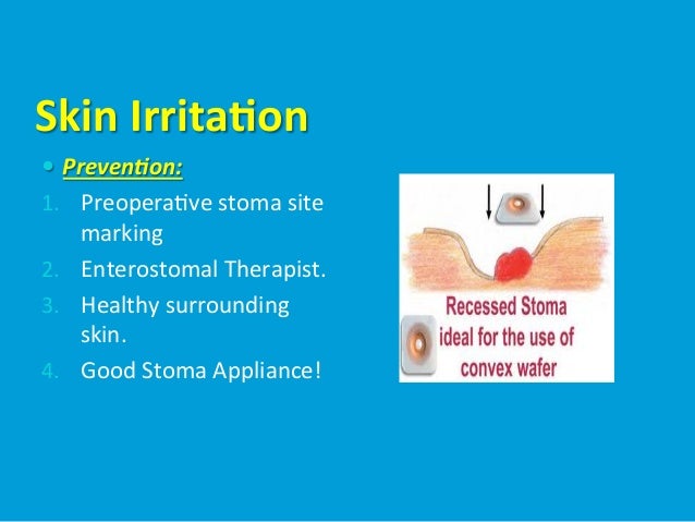 Colostomy complications