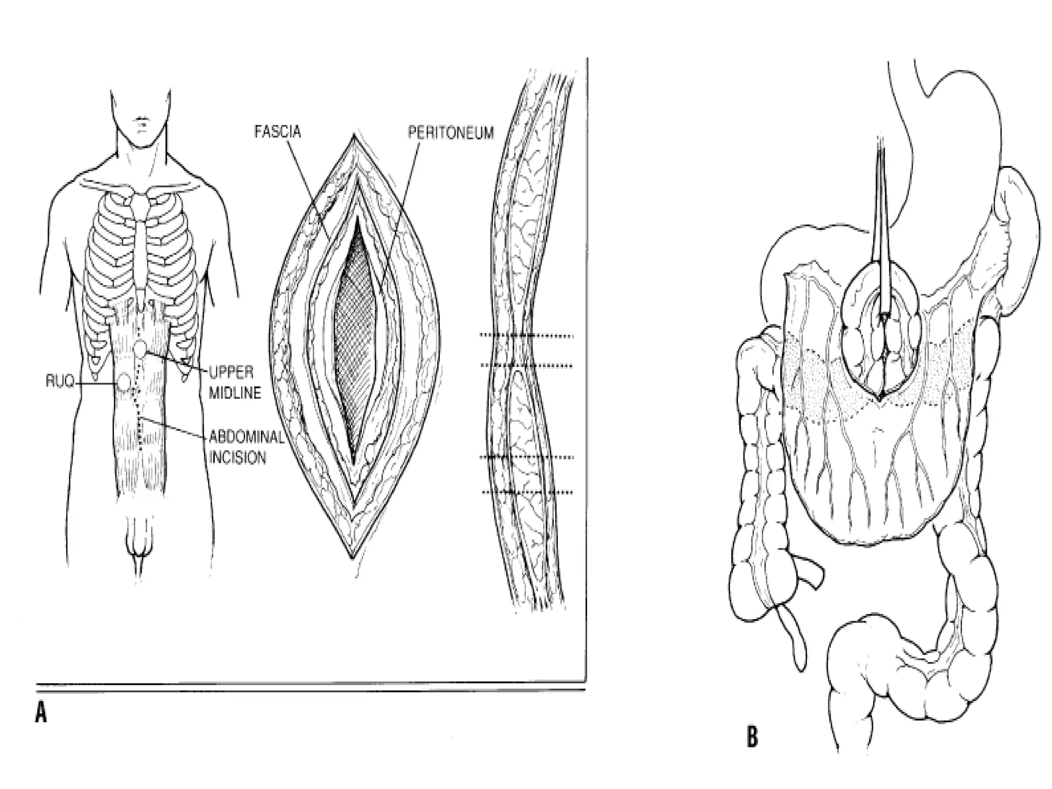colostomy (Stoma surgery -- Gastrointestinal).pptx