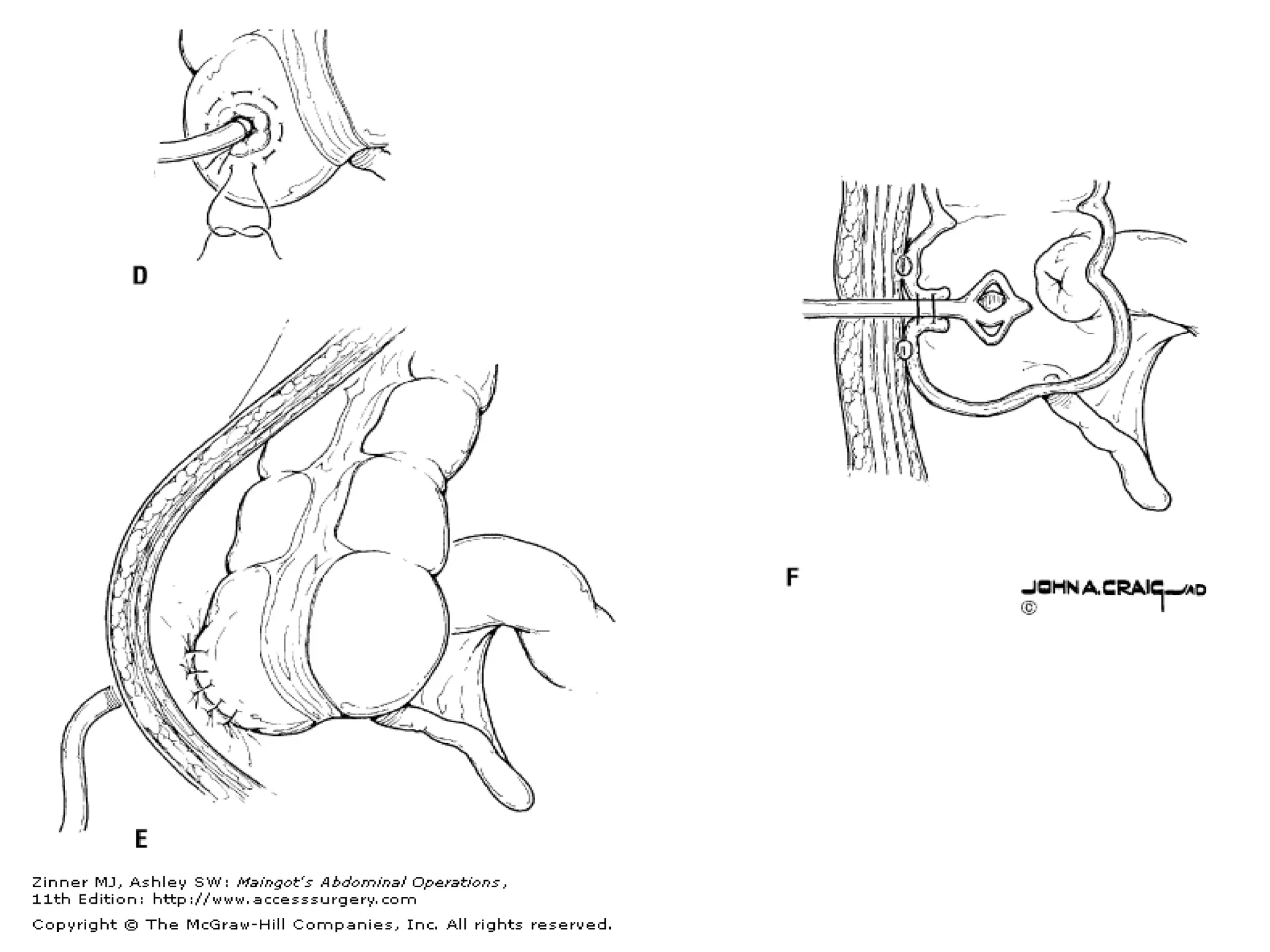 colostomy (Stoma surgery -- Gastrointestinal).pptx