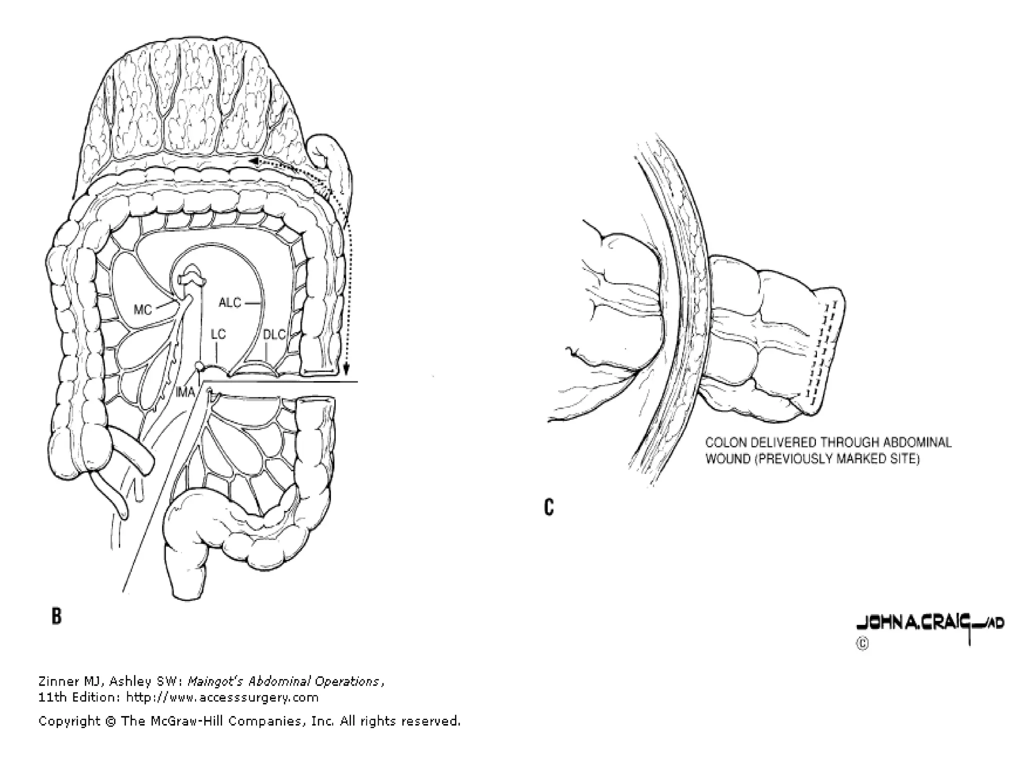 colostomy (Stoma surgery -- Gastrointestinal).pptx