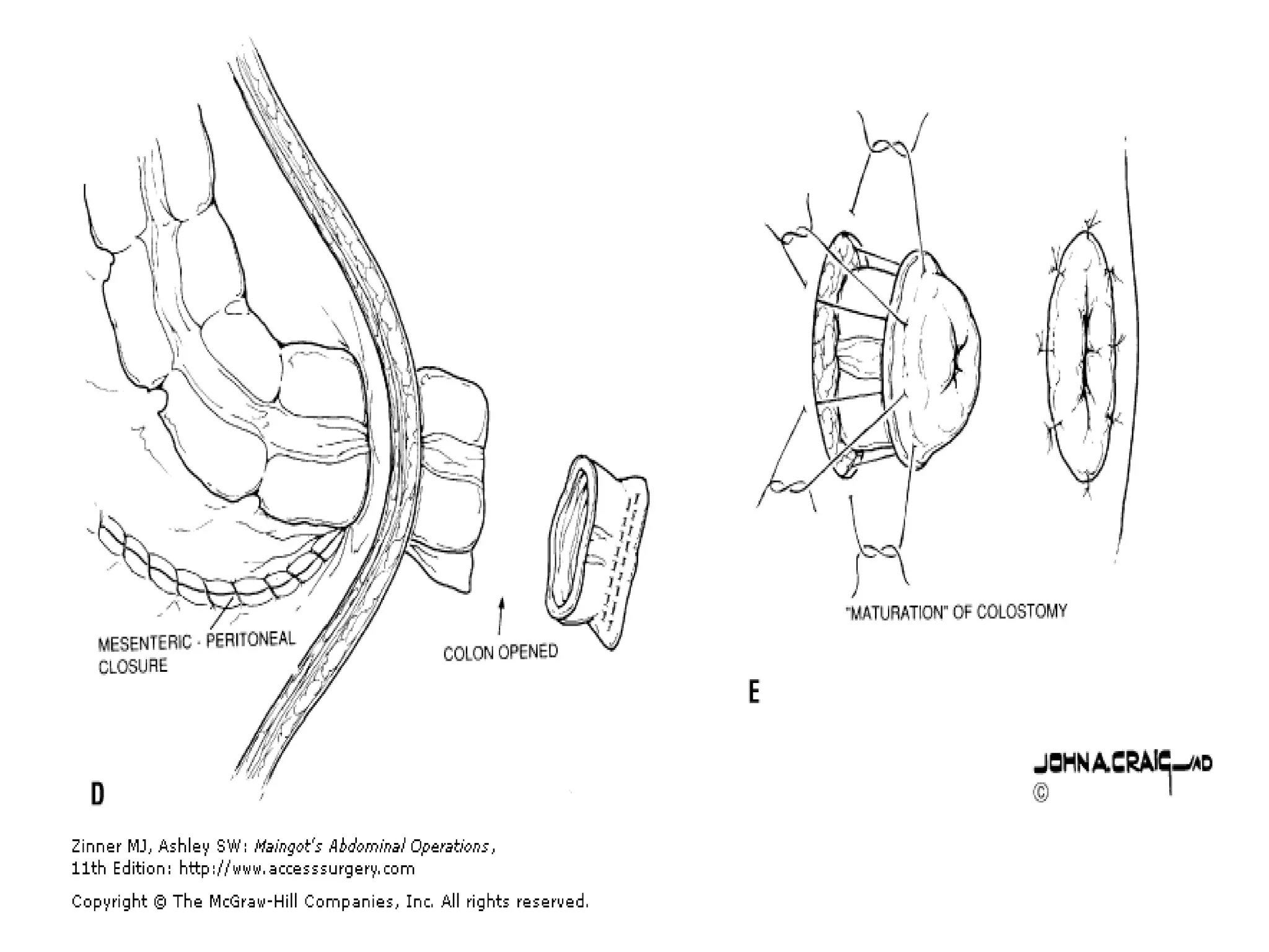 colostomy (Stoma surgery -- Gastrointestinal).pptx